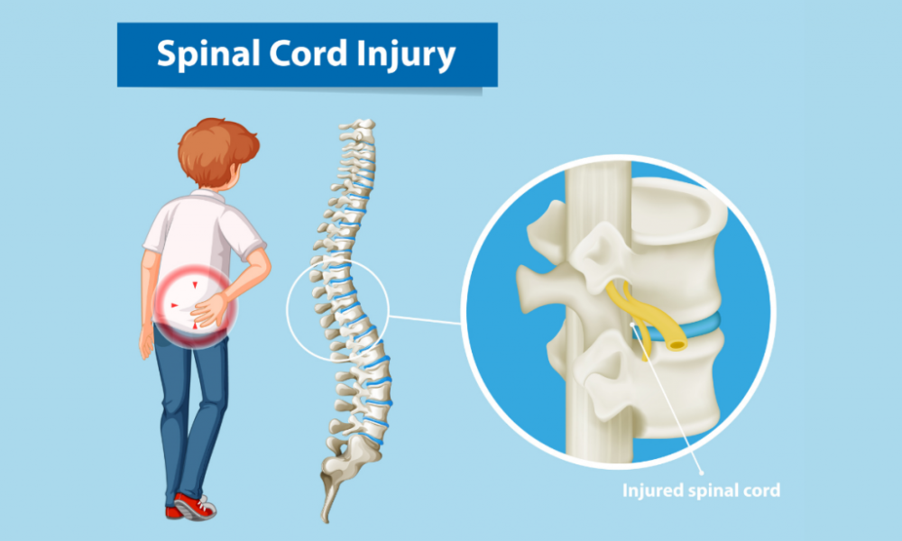 How Spinal Cord Injuries Affect Your Day-to-Day Life